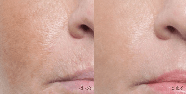 Skin Discoloration On Face